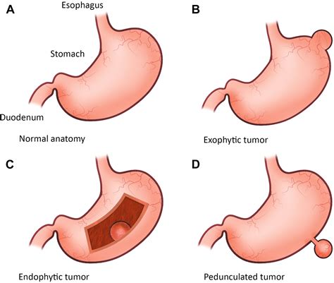 Surgical Management Of Gastric Gastrointestinal Stromal Tumors