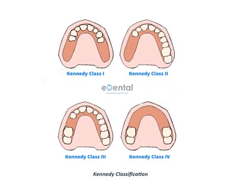 Kennedy Classification And Applegates Rules In Removal Partial
