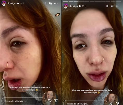 Flor Vigna Se Mostró Con Su Cara Muy Desfigurada Y Preocupó A Sus Fans