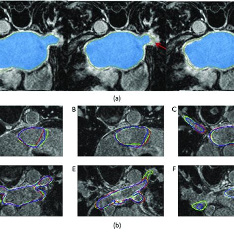segmentation maps of the left atrium superimposed on axial slices of