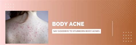 Body Acne Type Causes Symptoms Urban Skin And Hair Clinic