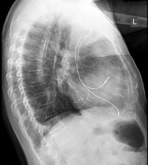 Biventricular Pacemaker Chest X Ray