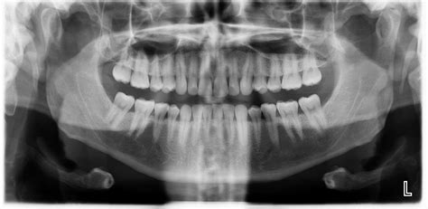 Normal Opg Landmarks At Helen Williamson Blog