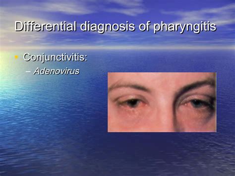 Pharyngitis Ppt
