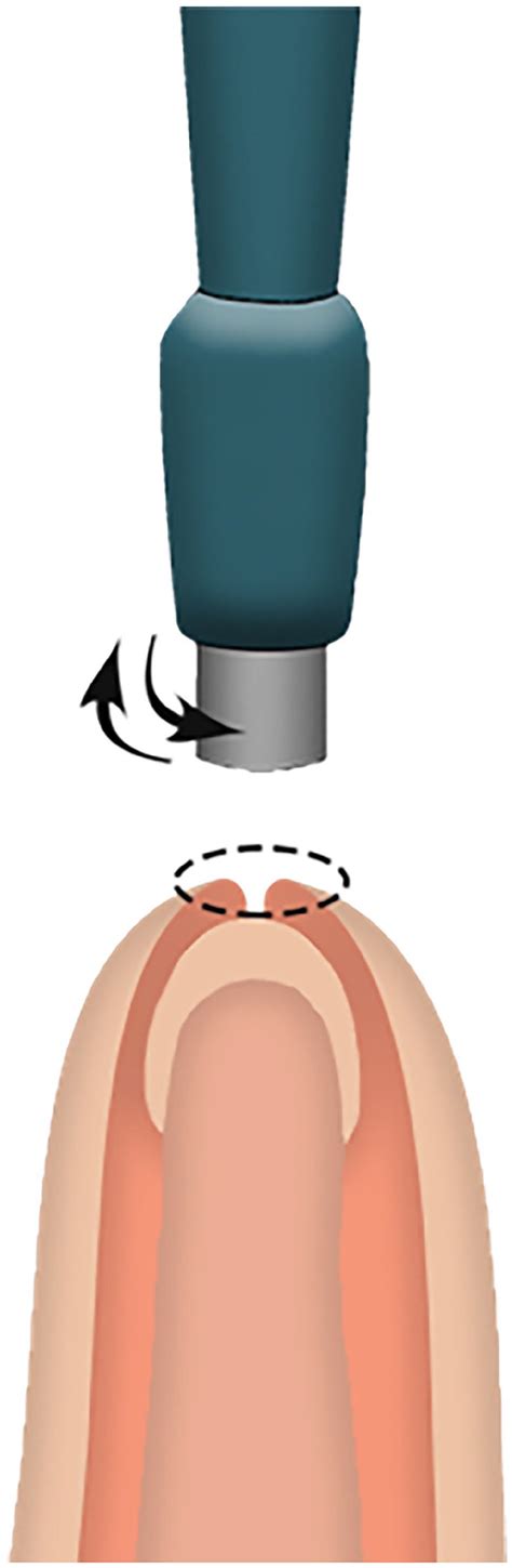 Modified Circumferential Preputioplasty Using A Keyes Biopsy Punch For