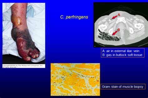 Myositis Pyomyositis Myonecrosis Flashcards Quizlet