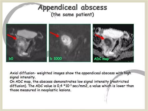 Presentation1 Radiological Application Of Diffusion Weighted Images In Abdome And Pelvic