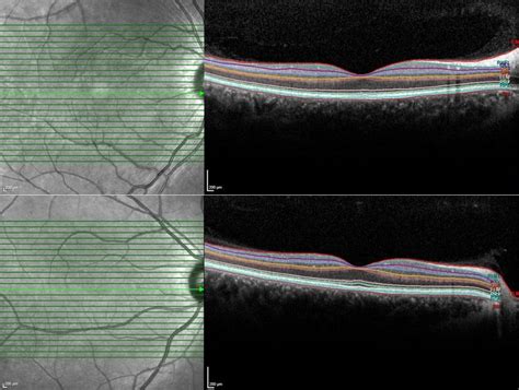 Differences Were Observed In The Thickness Of The Retinal Nerve Fiber