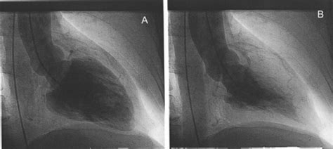A Left Ventriculogram In Diastole B Left Ventriculogram In Systole