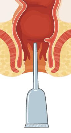 Soap Suds Enema Procedure