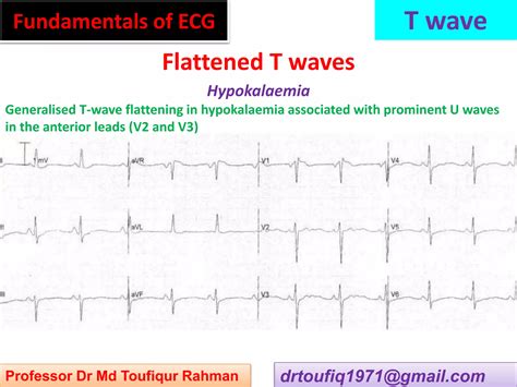 Approach To A Patient With T Wave Abnormality In Ecg Ppsx