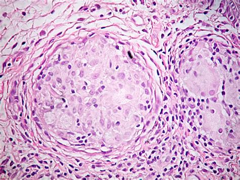 The Gingival Biopsy Showed The Presence Of Noncaseating Granulomas Hande