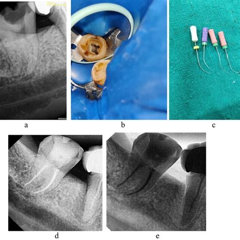 Pdf Endodontic Management Of Curved Canals In Mandibular Molars A Case Series