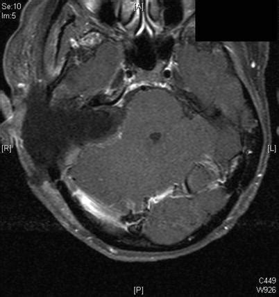 Infratemporal Fossa Approaches Neupsy Key