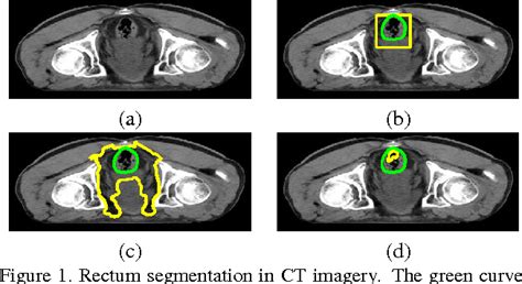Figure 1 From Level Set Segmentation With Both Shape And Intensity Priors Semantic Scholar