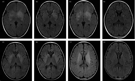 Autoimmune Basal Ganglia Encephalitis Associated With Anti N Methyl D