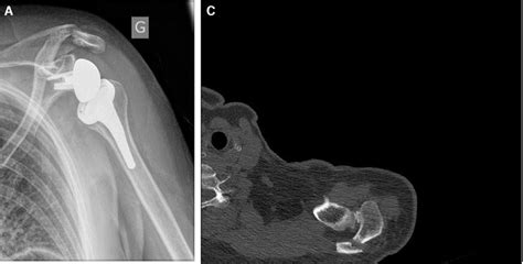 Uw Shoulder And Elbow Academy Acromion And Spine Fractures After Reverse Total Shoulder