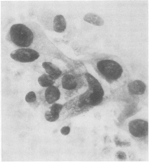 Imprint Of A Well Differentiated Pancreatic Ductal Carcinoma Showing