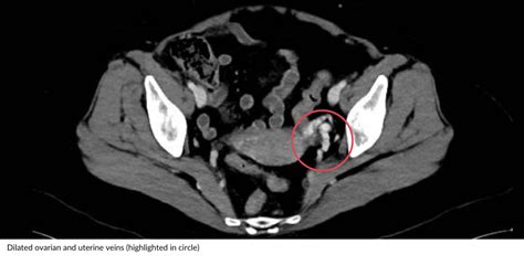 Pelvic Congestion Syndrome Vascular And Endovascular Clinic