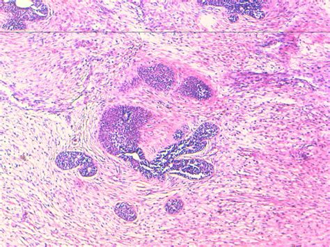 Teratomatous Components Of Neuroglial Cells And Immature Download Scientific Diagram