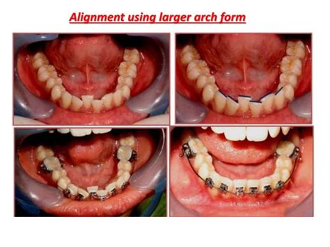 Orthodontic Alignment Of Teeth Part 3 Pptx
