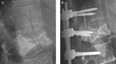 A Preoperative Segmental Kyphosis 15 Degrees B Postoperative