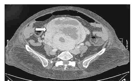 A Large Heterogeneous Mass Extending From The Pelvis Into The Upper
