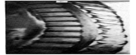 Granulomatous Angiitis Of The Spinal Cord A Case Report Neurosurgery