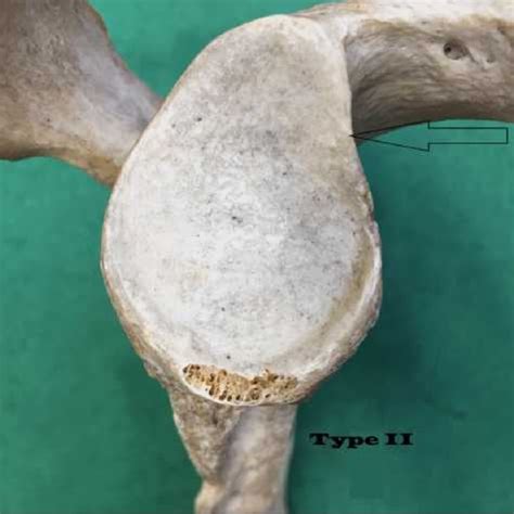 Pdf The Glenoid Notch And Its Clinical Implications