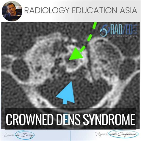 Cppd Crowned Dens Syndrome Ct And Mri Radiology Education Asia