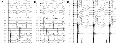Figure 1 From Intra Atrial Conduction Block During Radiofrequency Ablation Of Left Sided