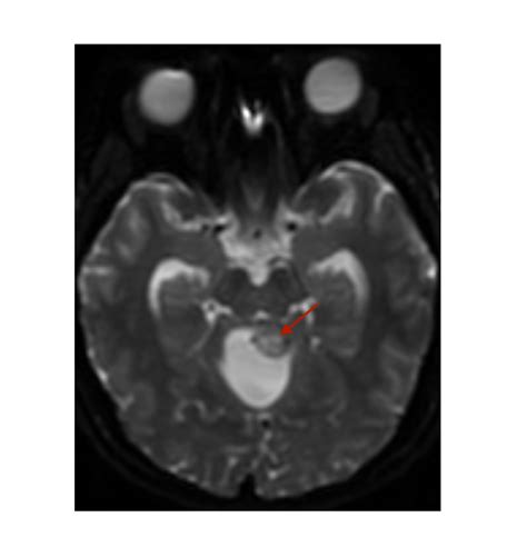 Cerebellar Haemangioblastoma Unveiled Exploring A Posterior Fossa