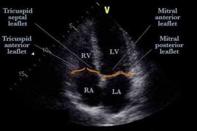Learn Echocardiography Standard Protocol For Performing Comprehensive