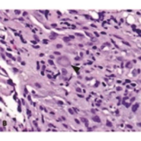 Colonoscopy Images Extensive Involvement Of The Terminal Ileum With