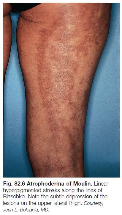 Follicular Atrophoderma