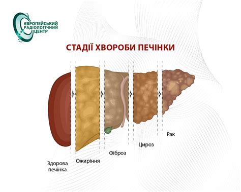 Захворювання печінки — новини ЕРЦ
