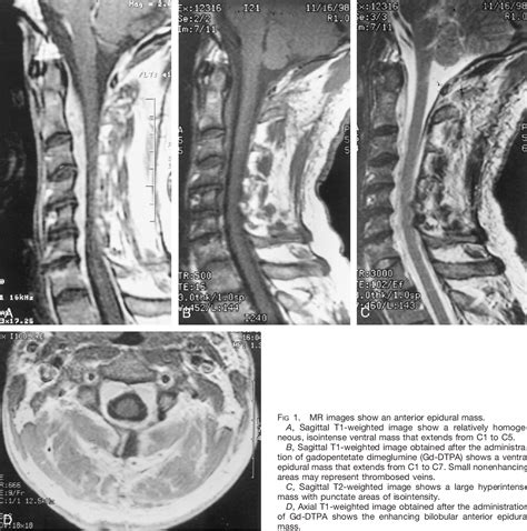 Figure 1 From Marfan Syndrome Epidural Venous Plexus In A Patient With