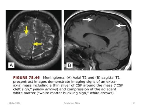 Diseases Of Brain Tumer Classification Of Brain Tumor Ppt