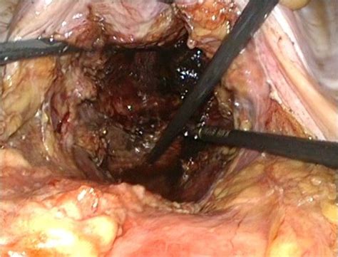 Case 1 Intra Abdominal View Of Bowel Loops Mobilized From Perineal
