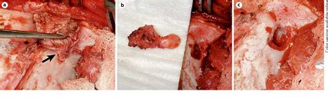 Figure 2 From Craniectomy For A Bilobed Dermoid Cyst In The Temporal Fossa And Greater Wing Of