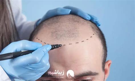 کاشت مو چیست؟ معرفی بهترین روش کاشت مو در ایران زیباشیم