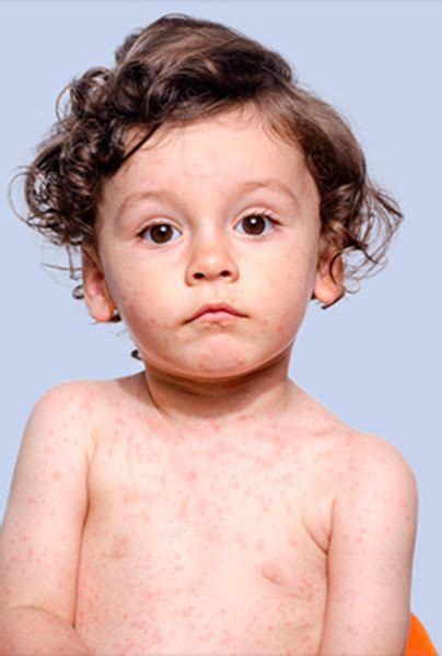 Los Distintos Tipos De Urticaria ¿sabes Cuáles Son Mui Fitness