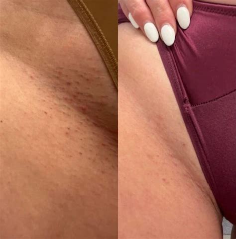 Intimate Area Bleaching Cream WooDerma