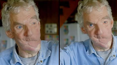 Man Who Had Face Ripped Off By Bear Dug Mud Out Of His Own Airways To Survive