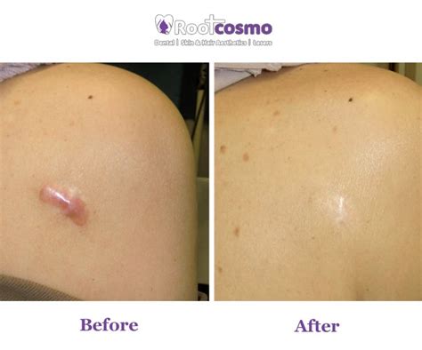 Rediscover Smooth Scar Free Skin With Expert Keloid And Hypertrophic