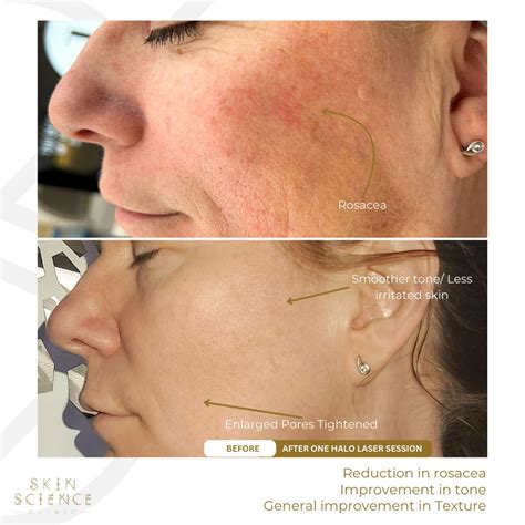 Bbl Treatment Skin Science Clinic