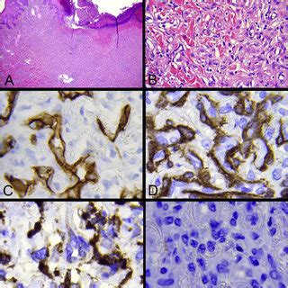 Microscopic Appearance Of Diffuse Dermal Angiomatosis A Low Power And Download Scientific