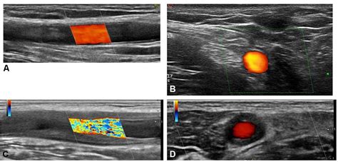 Temporal Artery Ultrasound Cranial Arteritis Temporal Arteritis