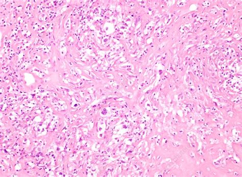 Nodular Sclerosis Hodgkin Lymphoma Light Micrograph Stock Image C051 0549 Science Photo