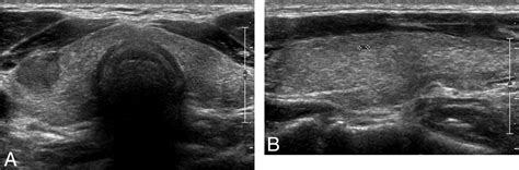 Thyroid Diffuse Hyperplasia